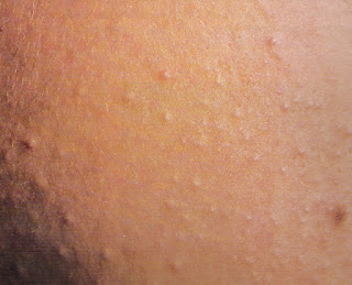 Beatriz Bertolazzi: Distúrbio Estético: Acne
