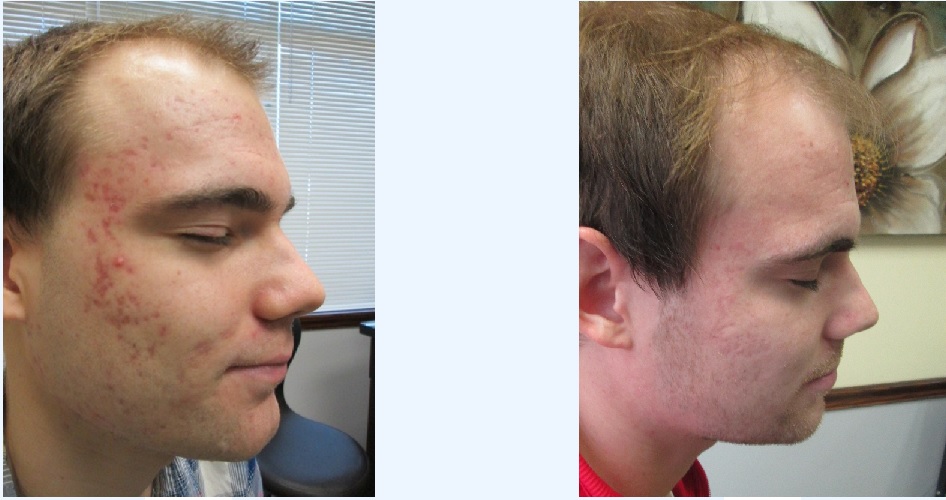 Your Skin for Life: Laser Treatments for Acne and Acne Scarring