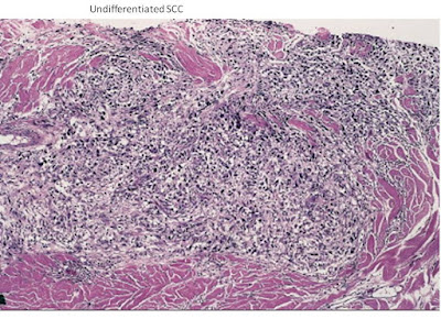 Dermpath Made Simple - Neoplastic: Squamous cell Carcinoma
