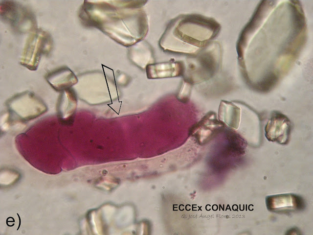 Caso UR- marzo-13 (Enfoque: cristaluria)