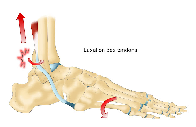 Blog 75: Infos santé : Sport et Santé-Entorse de la cheville