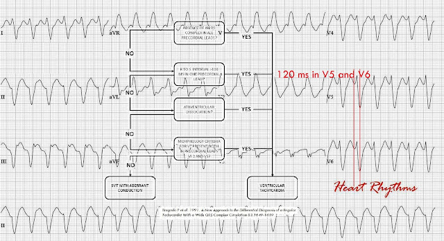 ECG Rhythms: Wide QRS Tachycardia