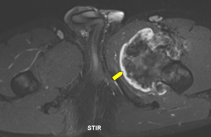 mricases: Large Sessile Osteochondroma Of The Lesser Trochanter Of ...