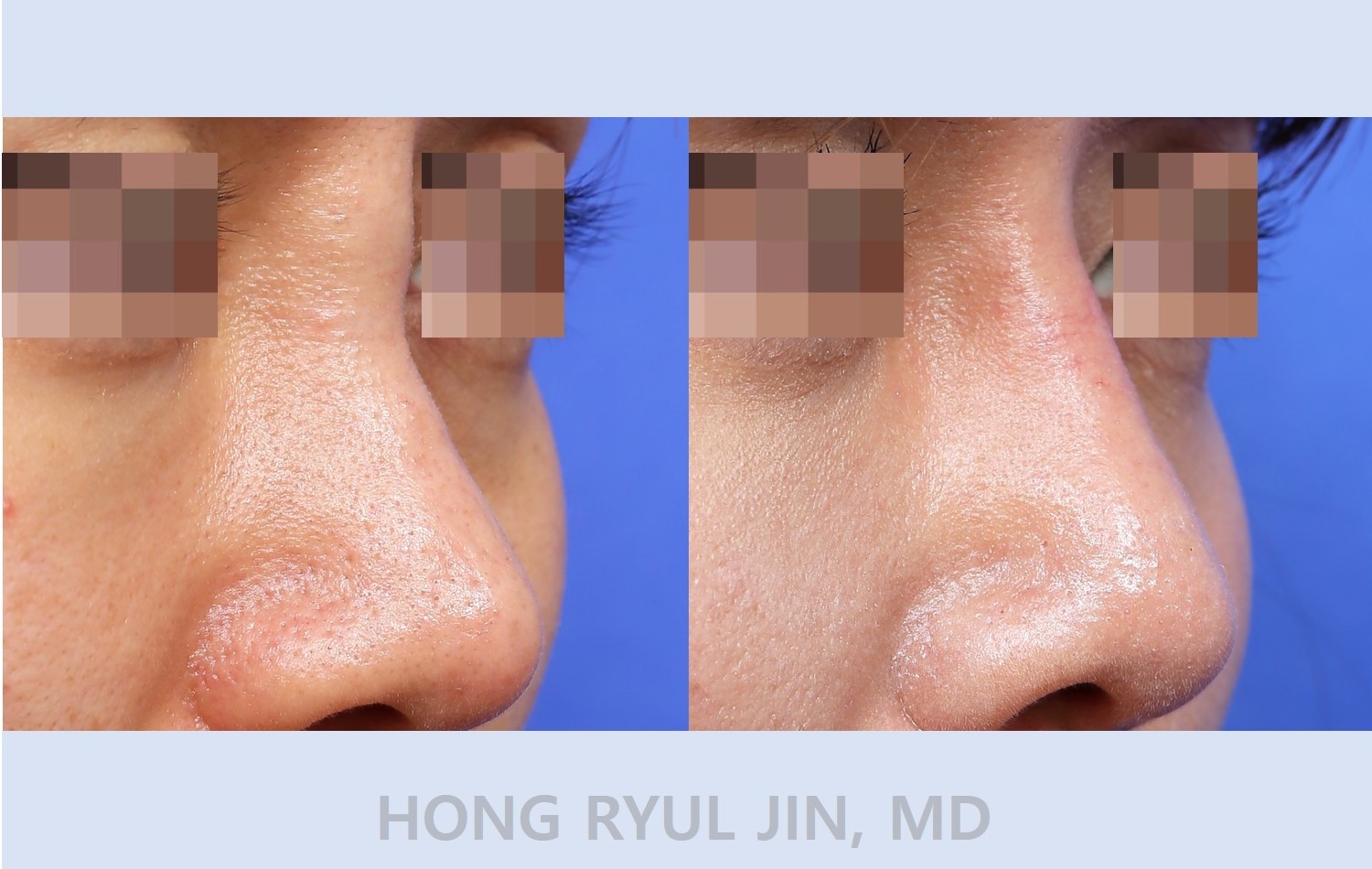 nasal filler removal