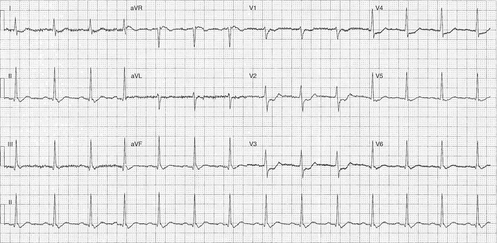 ECG of the Week: ECG of the Week - 22nd July 2013 - Interpretation