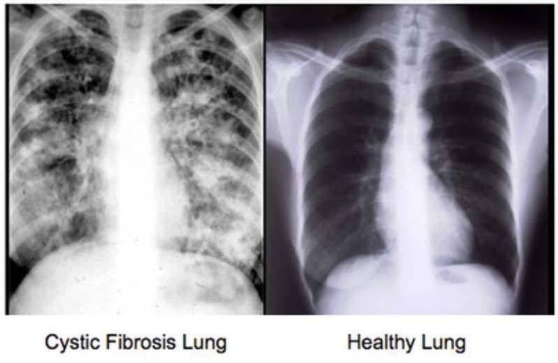 CYSTIC FIBROSIS by Anna Casas | MALALTIES GENÈTIQUES