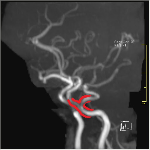 Persistent Trigeminal Artery