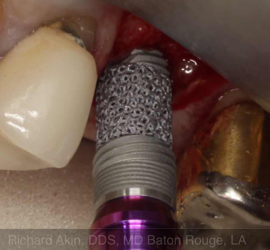 Capital Study Club: Trabecular Metal Implant Insertion: Site #14