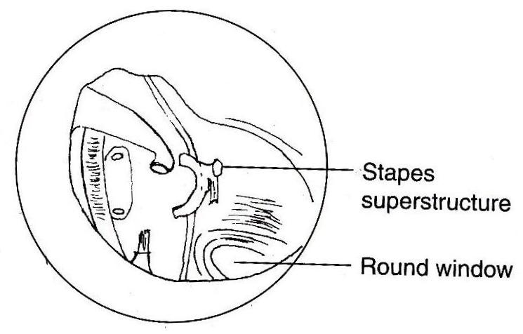 MBBS DOCTORS: OTOSCLEROSIS