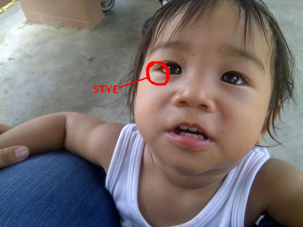 The Supermak Story by IntanPanda: Mata Baby Ada Infection?