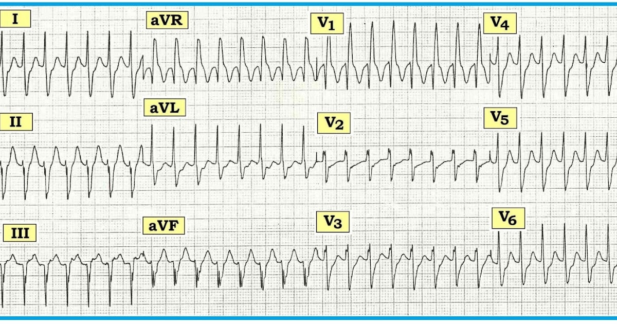 ECG Interpretation: ECG Interpretation Review #38 (WCT - SVT - VT ...