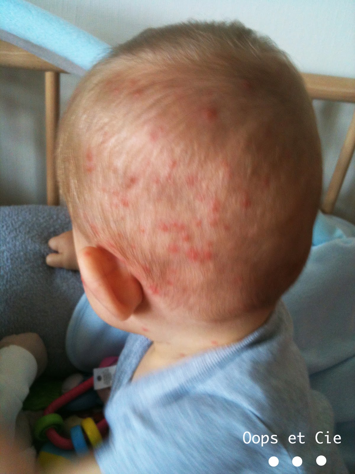 Oops & Cie: Il y a un an, tu avais la varicelle