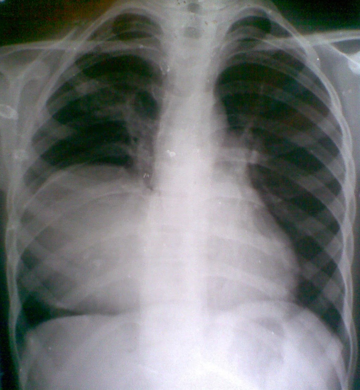Telethorax