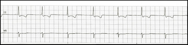 Practice ECG Rhythm Strips 100
