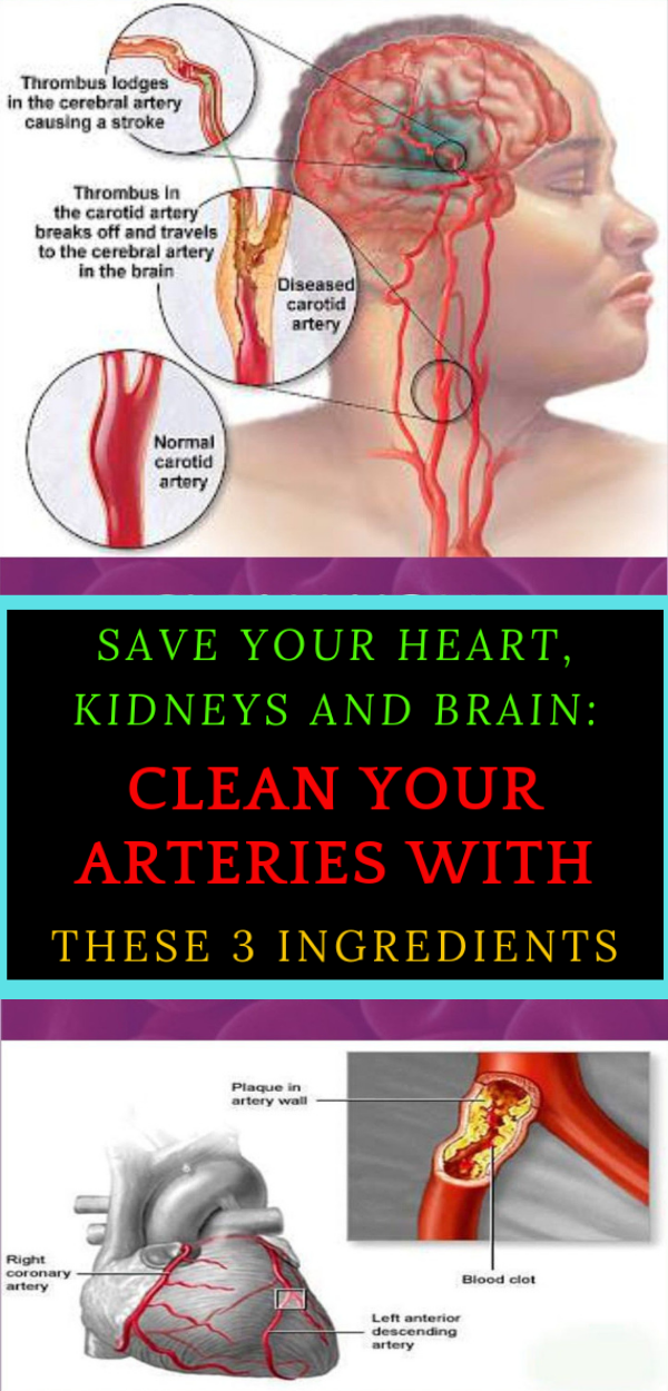 SAVE YOUR HEART, KIDNEYS AND BRAIN: CLEAN YOUR ARTERIES WITH THESE 3 ...