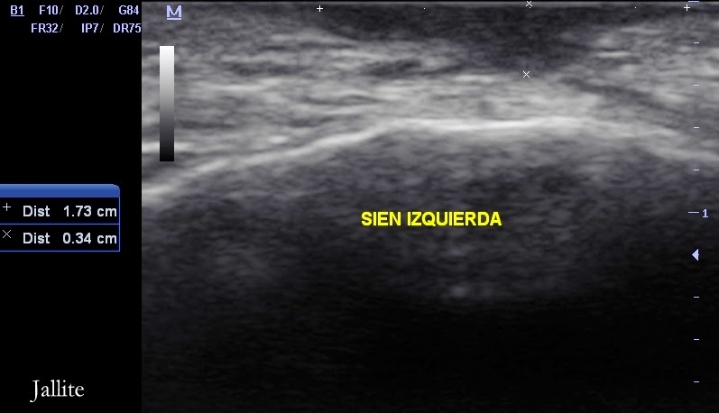 Abscesos Multiples en Cara