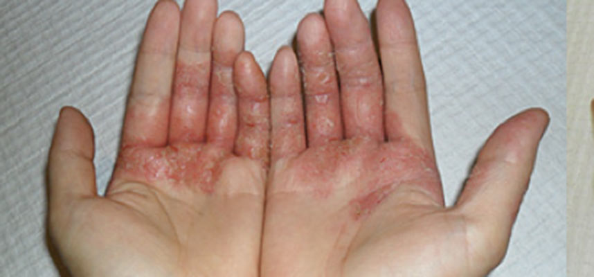 Pengertian dan Penyebab Eksim Atopik (Penyakit Gatal) - NATURE AMPUH