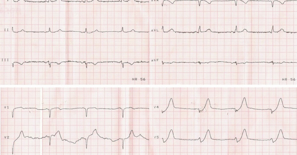 ECG Rhythms: De Winter's ST/T ECG changes in huge anterior wall MI