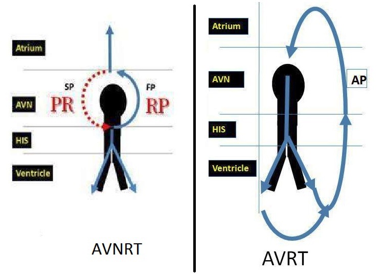 ECG Rhythms: A non-traditional way of looking at an arrhythmia