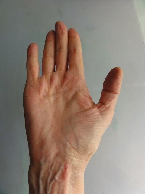 Wrist in plaster cast or finger injury - how to remove stiffness or ...