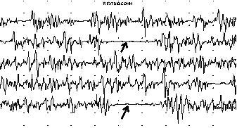 Cerebro conocerle: Asterixis (flapping tremor)