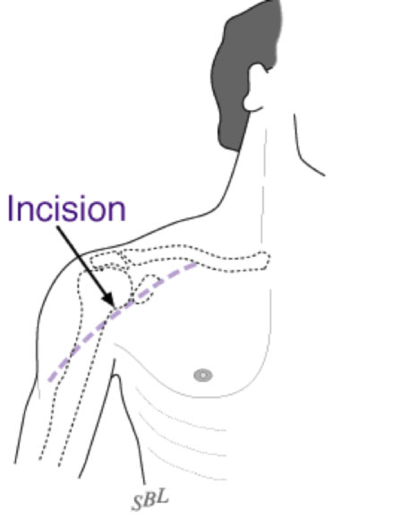 UW Shoulder and Elbow Academy: Shoulder joint replacement step by step ...