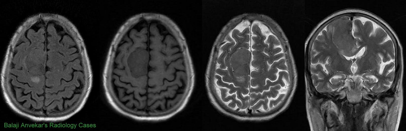 Dr Balaji Anvekar's Neuroradiology Cases: Meningioma MR Spectroscopy