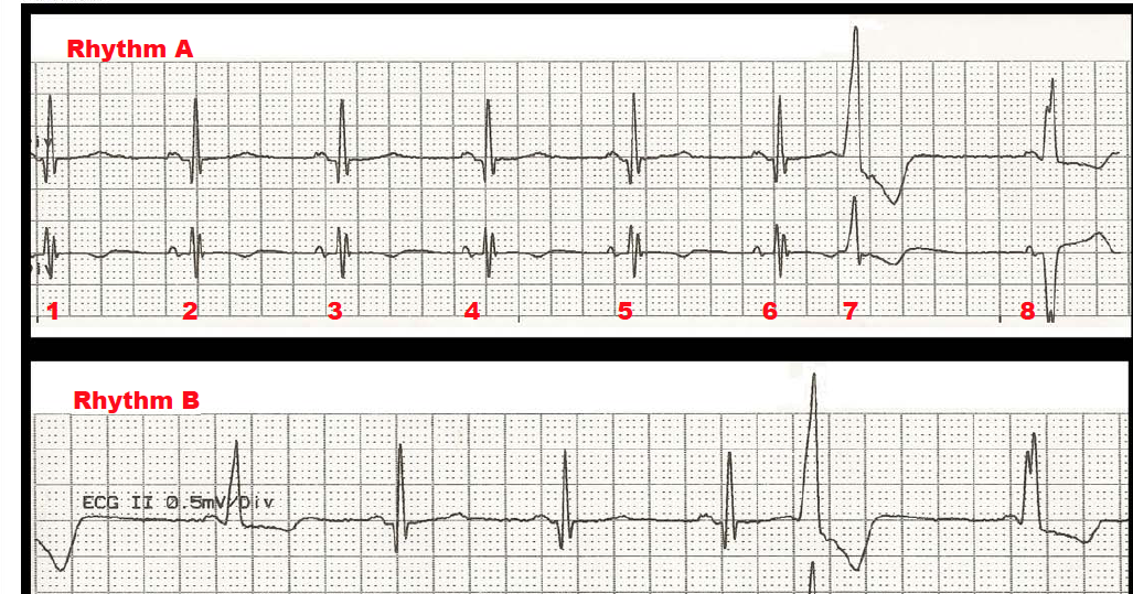 Float Nurse: Ventricular Escape Beats and Fusion Beats with ...