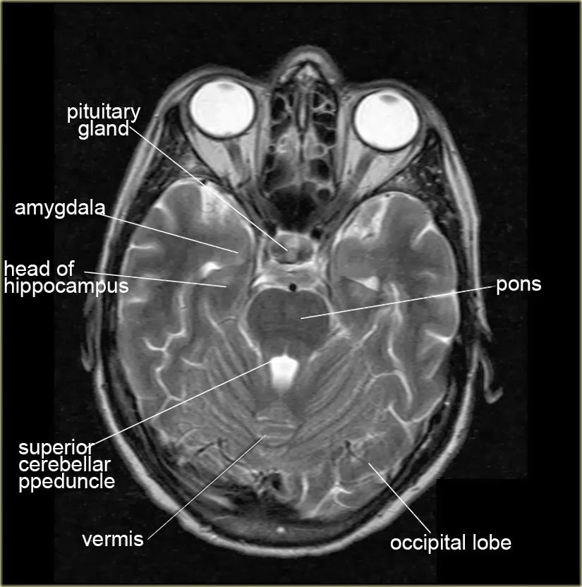 .: Brain Scan ( CT Scan Otak / Kepala )