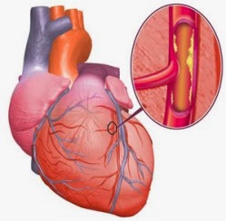 3 Pencegahan Penyakit Kardiovaskular - Artikel Kesehatan