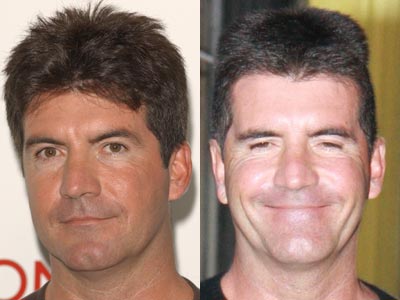 Simon Cowell Plastic Surgery
