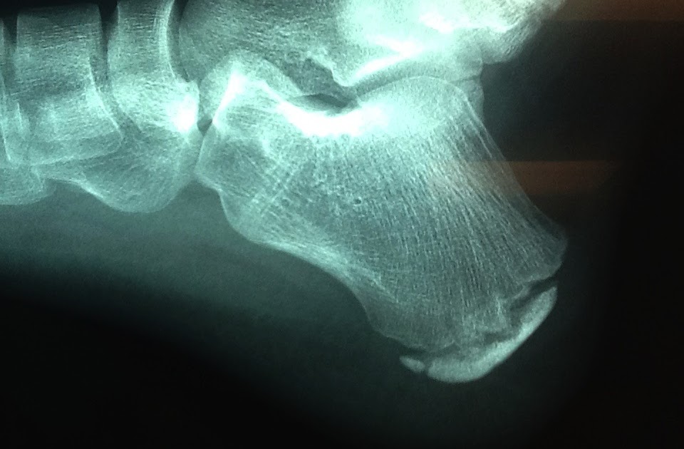 Foot and Ankle Problems By Dr. Richard Blake: Calcaneal Apophysitis ...