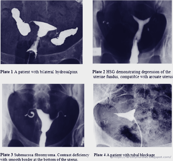 Fertility Solutions: Hysterosalpingogram