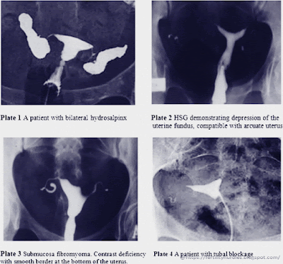 Fertility Solutions: Hysterosalpingogram