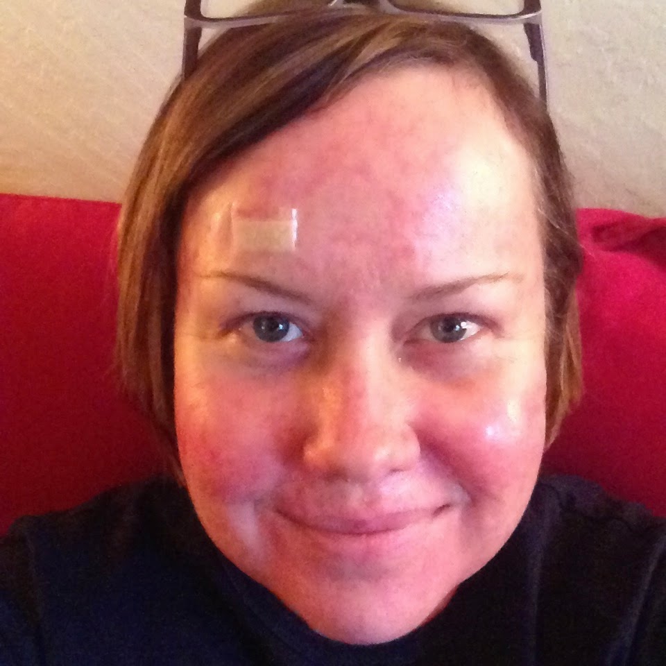 Efudex (Fluorouracil) Adventure: Day 21