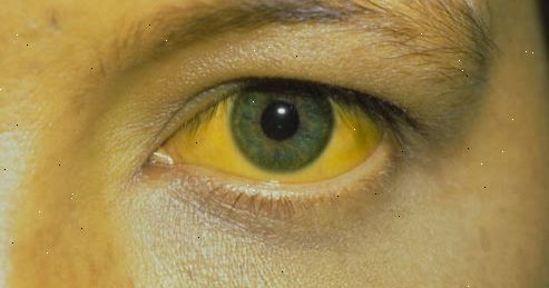 Jaundice Definition - What Is Jaundice | Health And Beauty