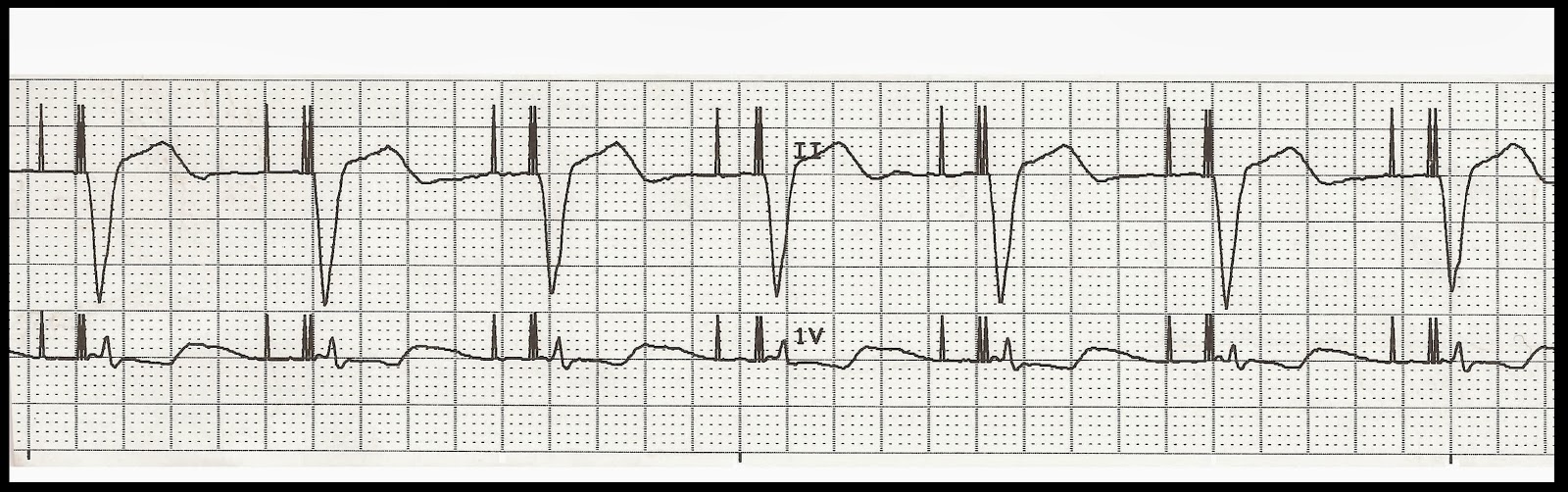 Basic EKG Rhythm Test 14