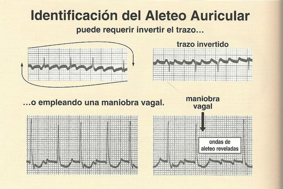 Electrocardiograma: Aleteo auricular