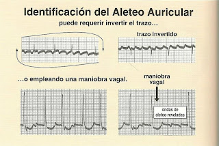 Electrocardiograma: Aleteo auricular