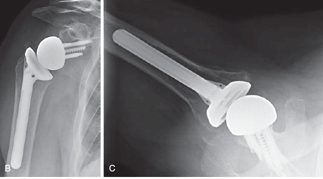 Shoulder Arthritis / Joint Replacement : Perfusion and stiffness of the ...