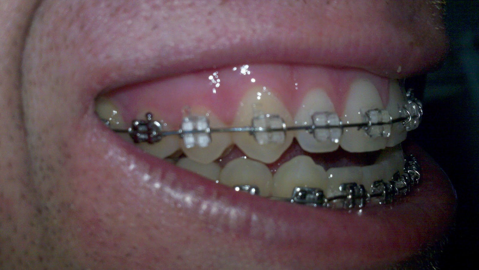 Braces/Open Bite Surgery: FINALLY Sure Smile Wires are in!
