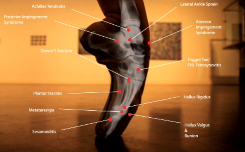 Ballet Injuries - Pictures