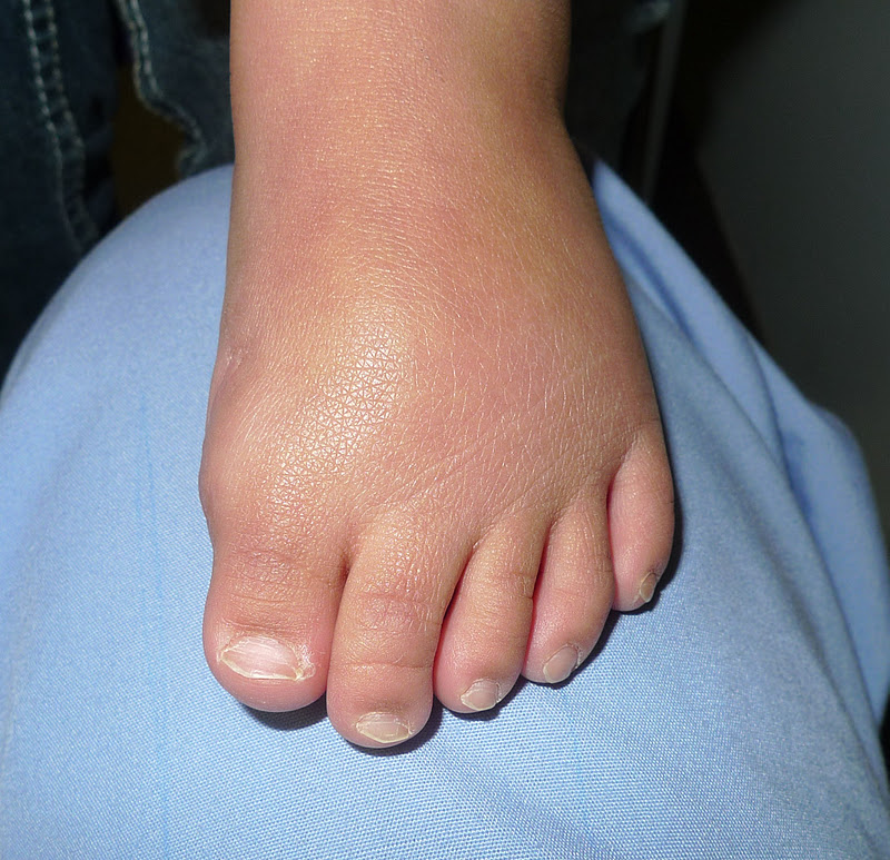 Toe Polydactyly | Congenital Hand and Arm Differences | Washington ...