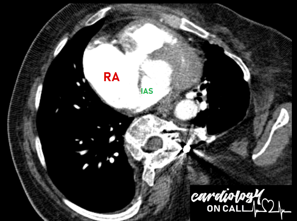 [CASE] SOB in a patient with history of lobectomy in childhood