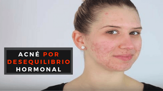 El acné y las hormonas
