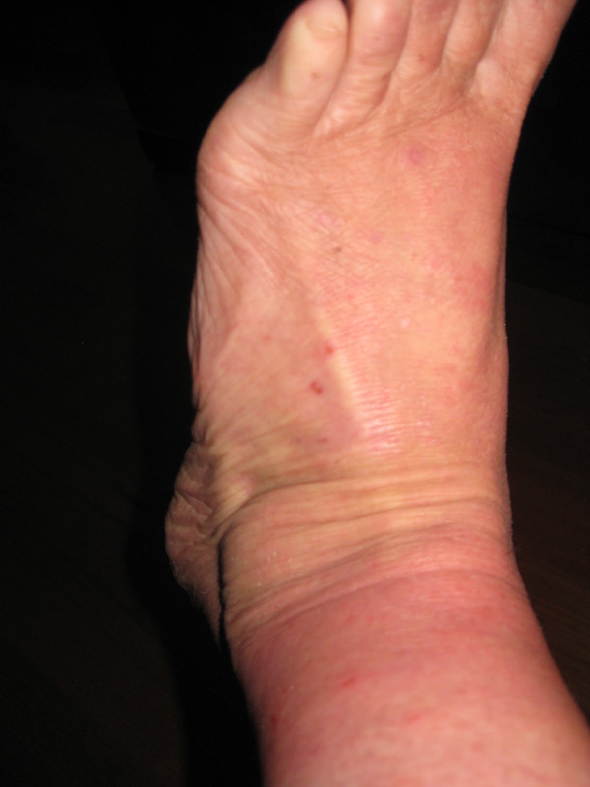 Topical Steroid Withdrawal Journey-Healing Eczema and Red Skin Syndrome ...