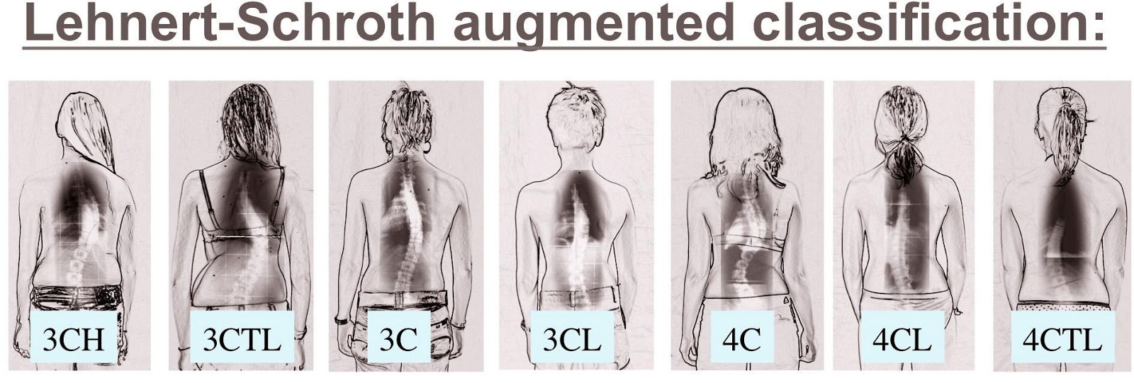 Scoliosis: Introduction of Schroth Method