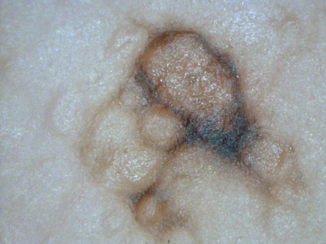 Dermatoscopia de máculas hipercrômicas