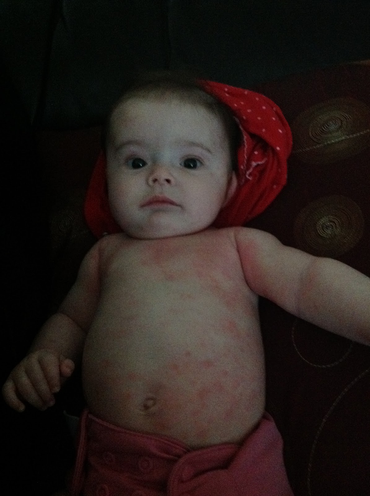 Little Miracles: Pictures of my Poor Babies Rash