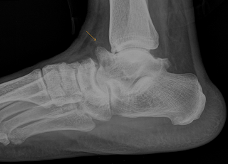 Talar Beak Sign-Plain film - Sumer's Radiology Blog